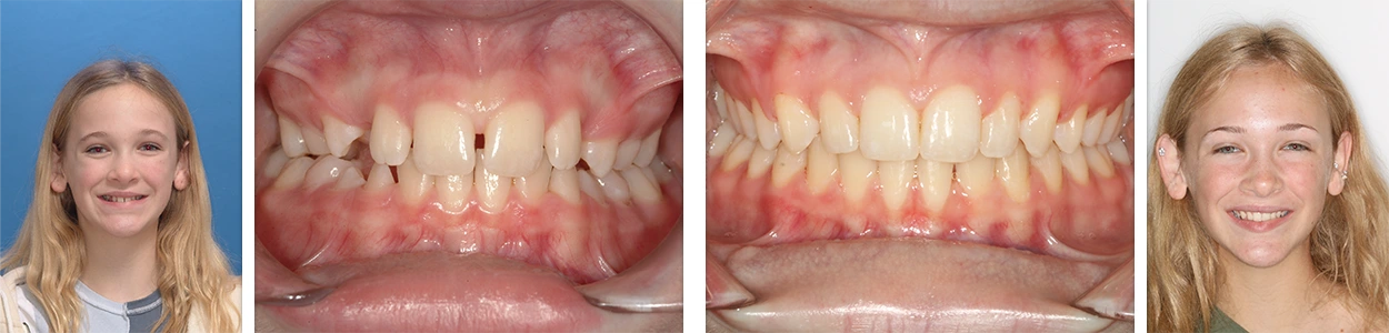 Smile Gallery - Walker & Wright Orthodontics